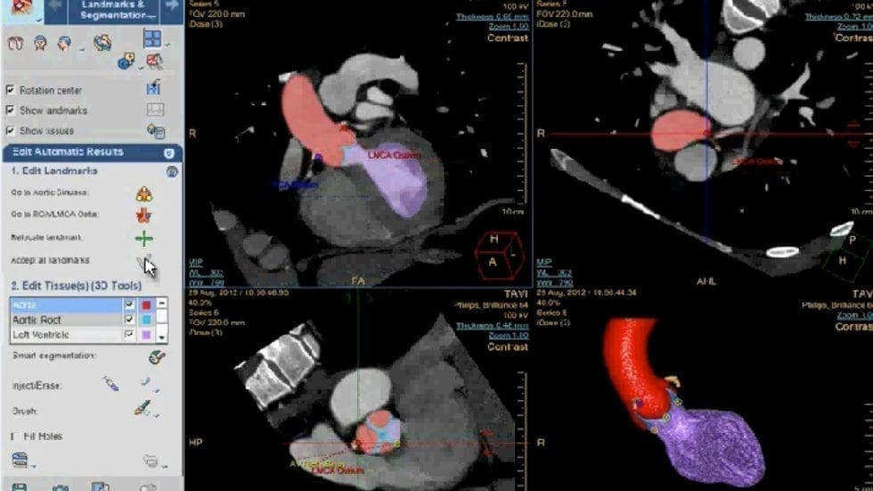 TAVI-CT - Osypka Herzzentrum München