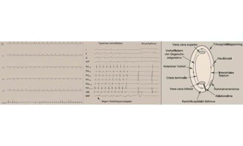 Vorhofflattern - Osypka Herzzentrum München